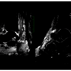 Major MRI Response in patient 2.