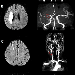 Representative cases of the four types of LAA mechanism.