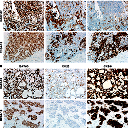 Examples of GATA3, CK20 and CK5/6 staining.