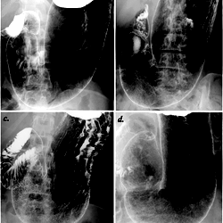Typical four images of stomach by double-contrast upper ...