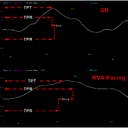 Representative image of SR and RVA pacing for LV rotation and twist in ...
