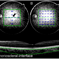 Item - The choroidal thickness map of a 57-year-old normal male ...