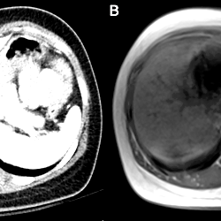 Quality of CT and MR images for TAMA measurement.