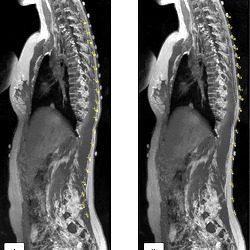 Sagittal plane maximum intensity projection.