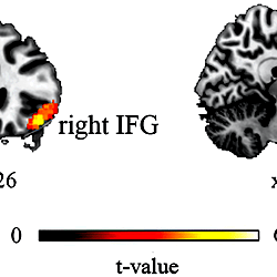 Brain activation associated with hindsight bias (HB).
