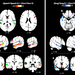 Statistical activation maps for Hum versus Song and Speech.