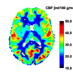 MRI, ASL perfusion map and analyzed brain regions.