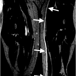 Multiplanar reformat of an MR-angiographic image of the great saphenous ...