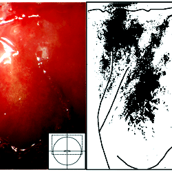Grainy sandy patches and mucosal bleeding.