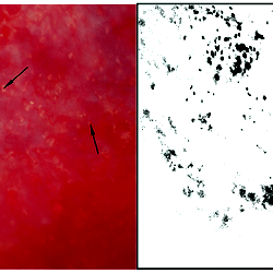 Grainy sandy patches and abnormal blood vessels.