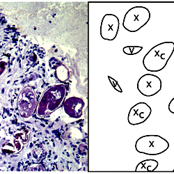 Histological correlate to the sandy patch in Figure 9.