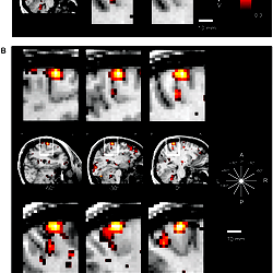 Differential interhemispheric connectivity map.