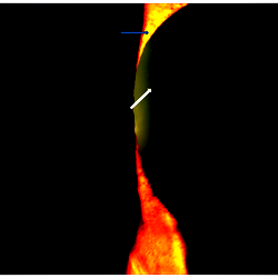 Slit lamp photograph showing radial pigmentary pattern of deposits on ...