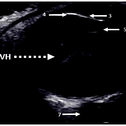 Ocular ultrasound examination of a vitreous haemorrhage (VH) in the ...