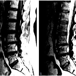 Modic type I changes in the lumbar spine (indicated by arrows).