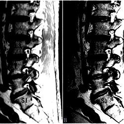 Modic type II changes in the lumbar spine (indicated by arrows).