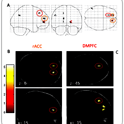 Bilateral rACC and left DMPFC/DLPFC correlated with the analgesic ...