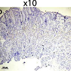 Identification of M. abscessus in gastric biopsy sections using ...