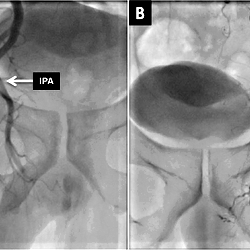 Angiographic findings of internal pudendal arteries.