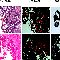 Laser capture microdissection (LCM) of epithelium from A) low- grade ...