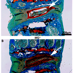 Chronic MG-H1 accumulation causes GAG loss.
