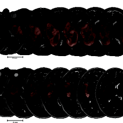 Examples of lesion volume segmentation and 3D rendering.