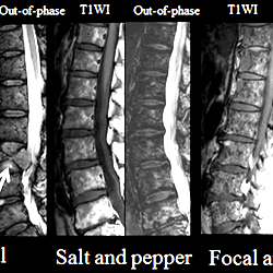 MRI of the lumbar spine shows infiltration patterns of multiple myeloma.