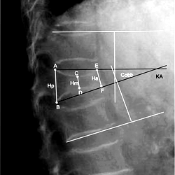 Radiographic measurement of vertebral body height in sagittal alignment ...