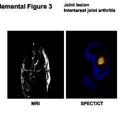 Comparison of SPECT/CT and MRI in Diagnosing Symptomatic Lesions in ...