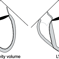 LV size and LV cavity volumetric assessment from the apical 4-chamber view.