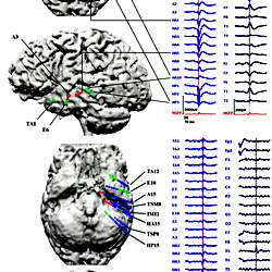 Locations of sEEG contacts inside the brain and epileptic activity ...