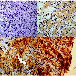 Intensity of PD-L1 staining.