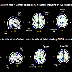 DTI maps show reduced fractional anisotropy (FA) (A) and increased ...