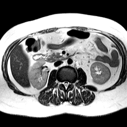 Abdominal MRI (T2-weighted sequence, axial slice), showing a small cyst ...