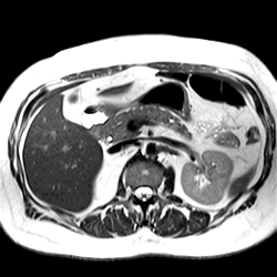 Abdominal MRI (T2-weighted sequence, axial slice), showing an ...