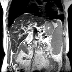 Abdominal MRI (T2-weighted sequence, coronal slice), showing a ...