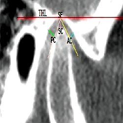 Sagittal view showing condyle joint space measurements.