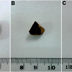 Cross sectional appearance of each type of gallstone.