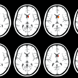 DTI measure differences between PD-CN and normal controls.