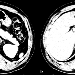Feasibility of thin-slice abdominal CT in overweight patients using a ...