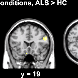Item - Experiment 1 Action Observation and Execution Task, ALS > HC ...