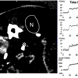 Axial perfusion CT image and time density curve corresponding to the ...