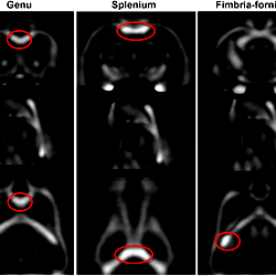 FA maps with circles indicating regions of the genu (right) and ...