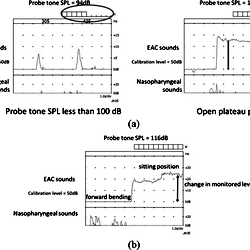 The characteristic of patulous eustachian tube patients diagnosed by ...