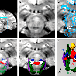 Process for reconstructing brainstem nuclei and fiber tracts in 3D from ...