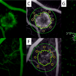 Illustration of area and intensity assessment of CNV lesions in FFA and ...