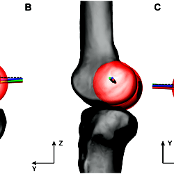 The positions and orientations of the transepicondylar axis (TEA ...