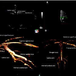 Magnetic resonance angiography and 3D of the caudal part of confluence ...