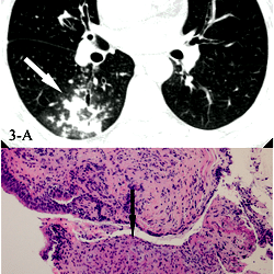 Reversed Halo Sign: Presents in Different Pulmonary Diseases - Fig 3
