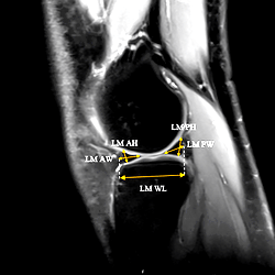 Mid-lateral sagittal section (LM AH) Lateral Meniscal Anterior height ...